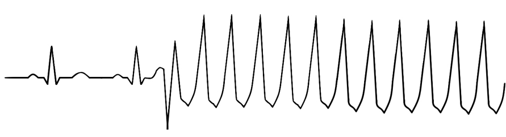 【心電図の読み方】心室性期外収縮の分類！危険なPVCと7分類！ | 臨床検査技師が教える病気と健康の相談所